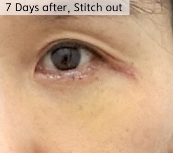 Lower Blepharoplasty in Korea | Natural-Looking Lower Eyelid Surgery