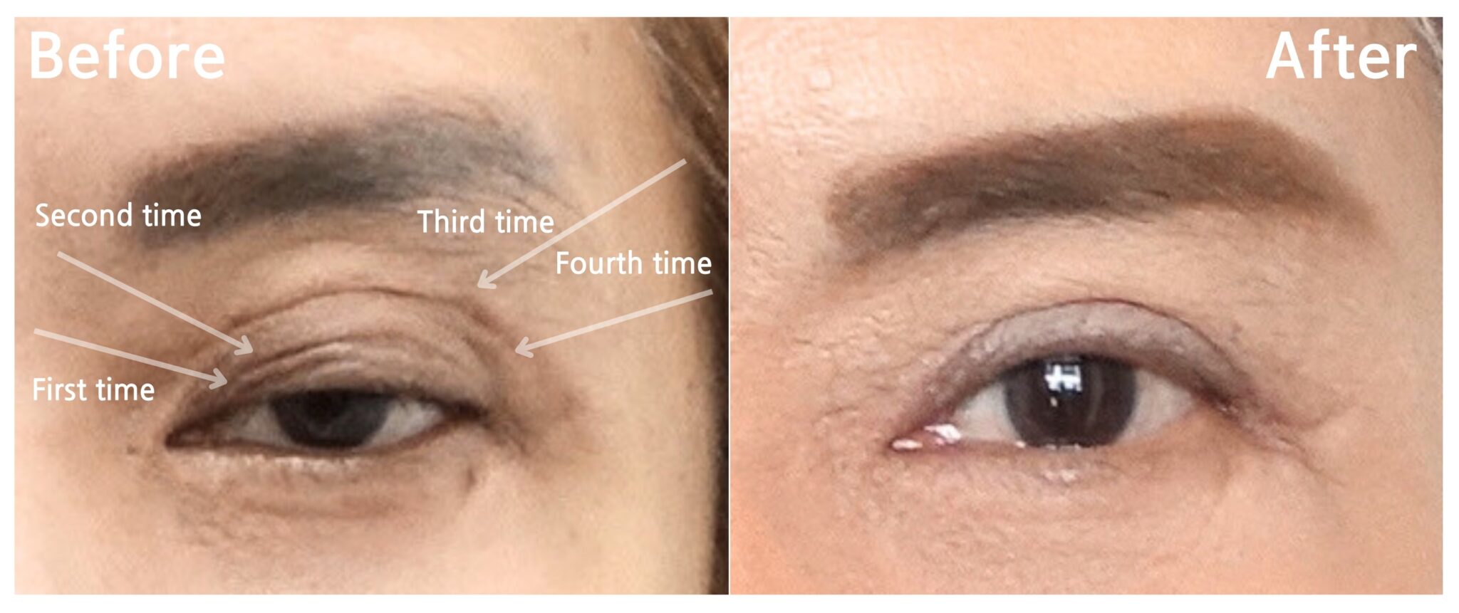 Multiple Eyelid Folds After Several Surgeries: Why Do They Occur ...