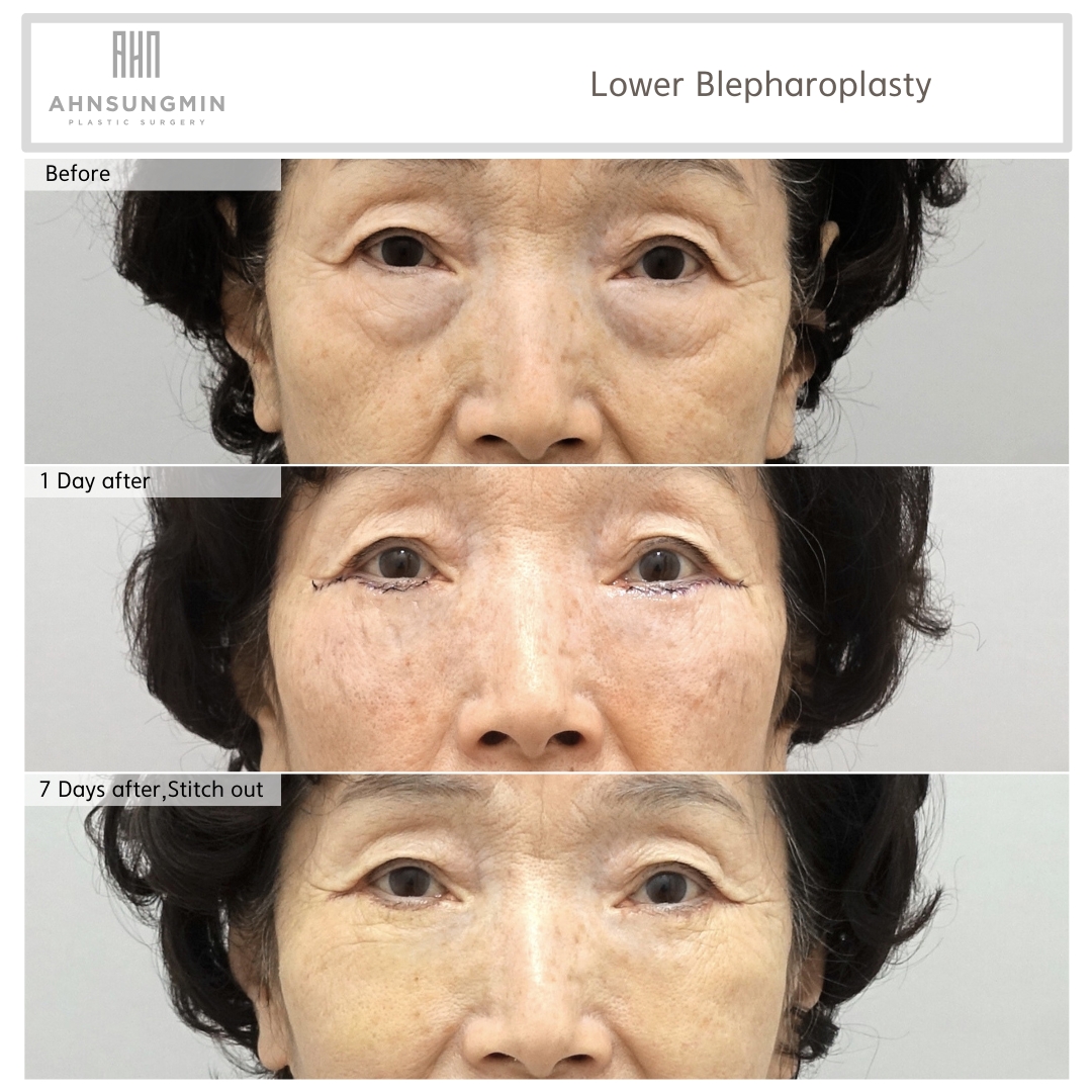 Lower eyelid surgery recovery process for a woman in her 70s ...