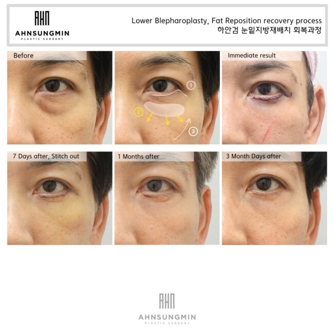 Lower Blepharoplasty in Korea | Natural-Looking Lower Eyelid Surgery