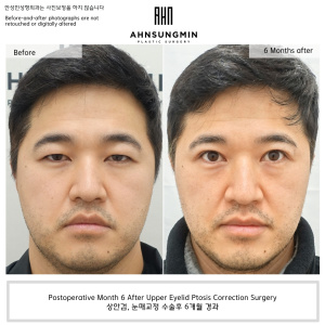 Before After - AHNSUNGMIN PLASTIC SURGERY