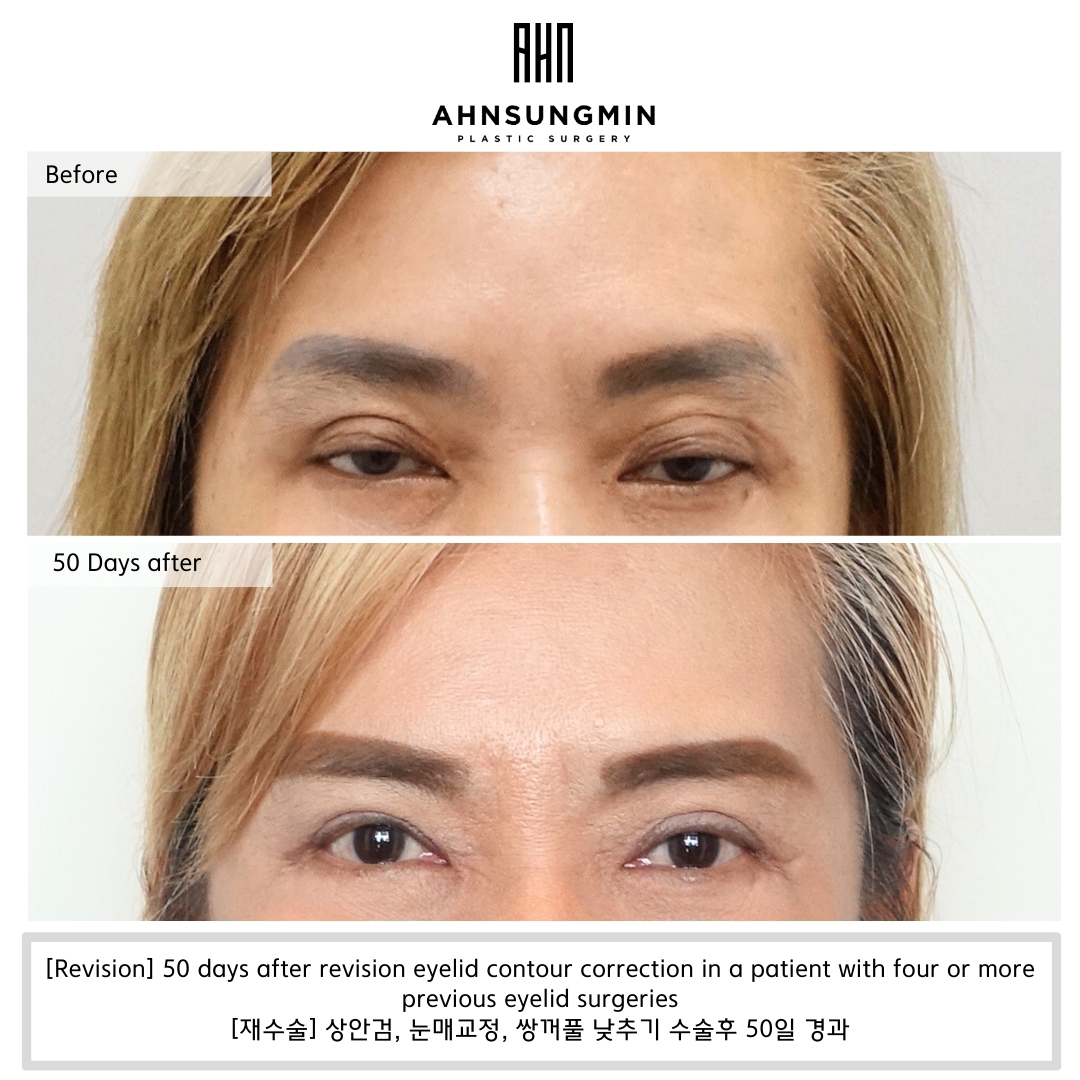 Multiple Eyelid Folds After Several Surgeries: Why Do They Occur ...