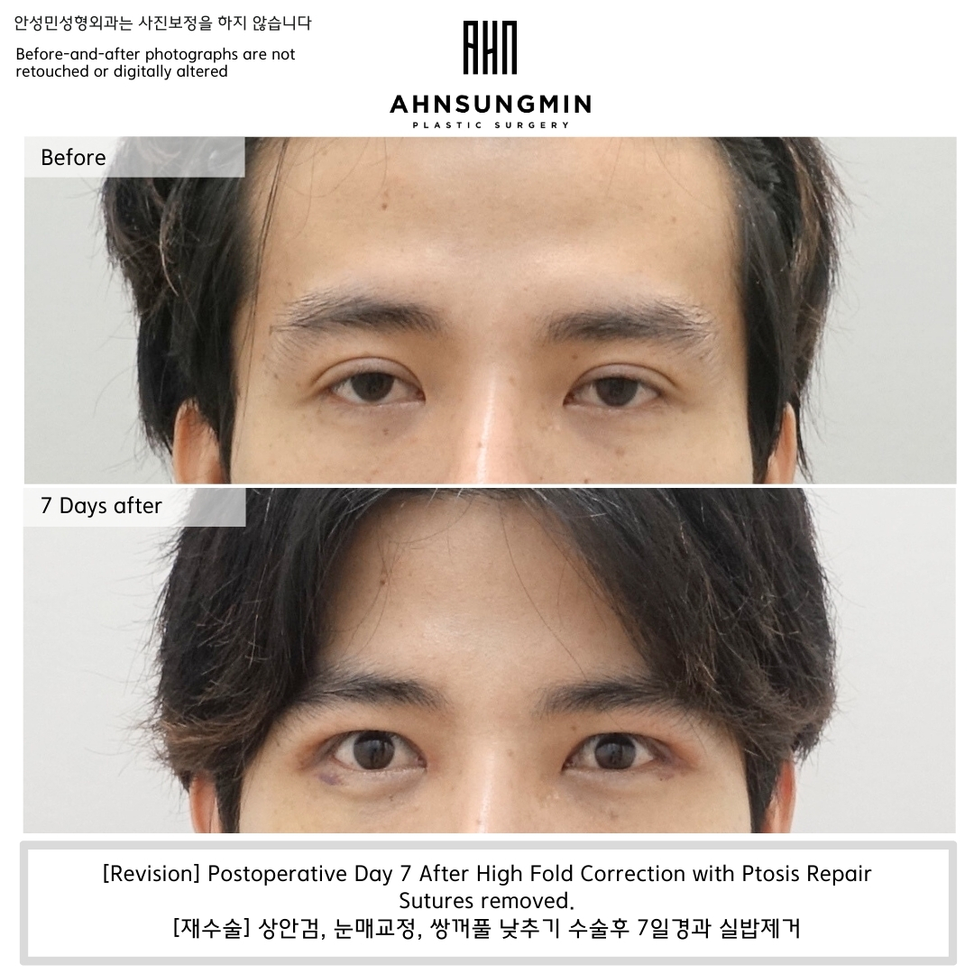 Why High Folds Form and How They Should Be Corrected