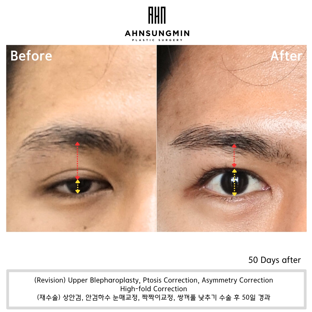 Why Thick Double Eyelid Creases May Actually Be Ptosis